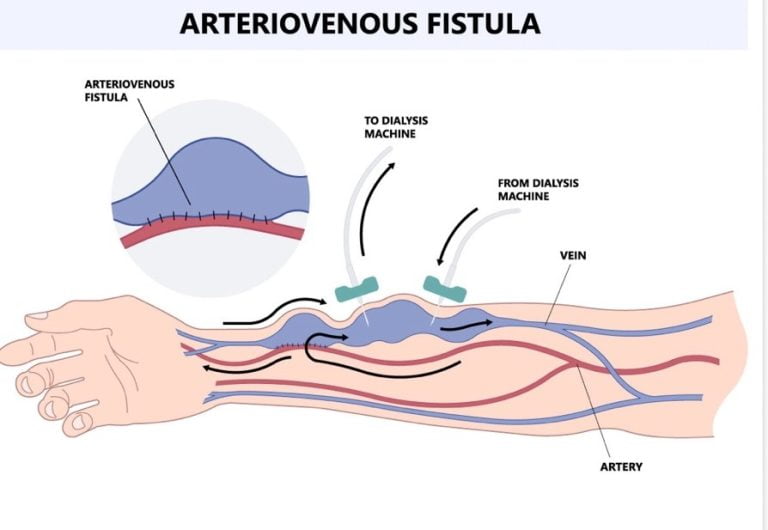 Arteriovenous fistula formation & dialysis - Dr Jill O'Donnell
